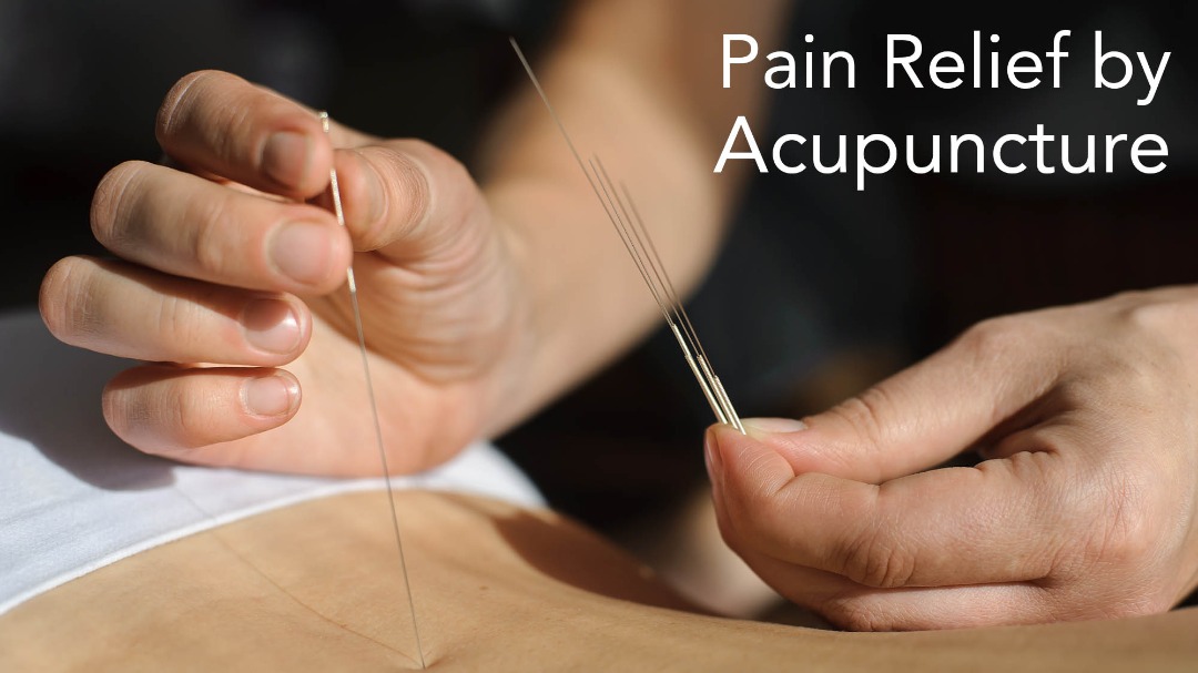 Alternate Pain Management Strategy through Acupuncture | iestory