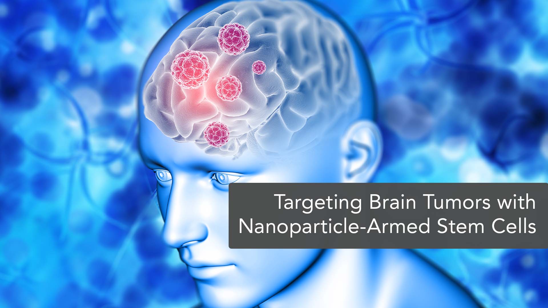 Precision Neuron Capture Therapy for Glioblastoma with Gadolinium-Loaded Stem cell–nanomedicine ...